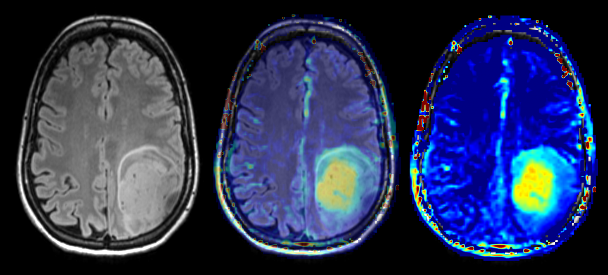 APT CEST – Olea Medical