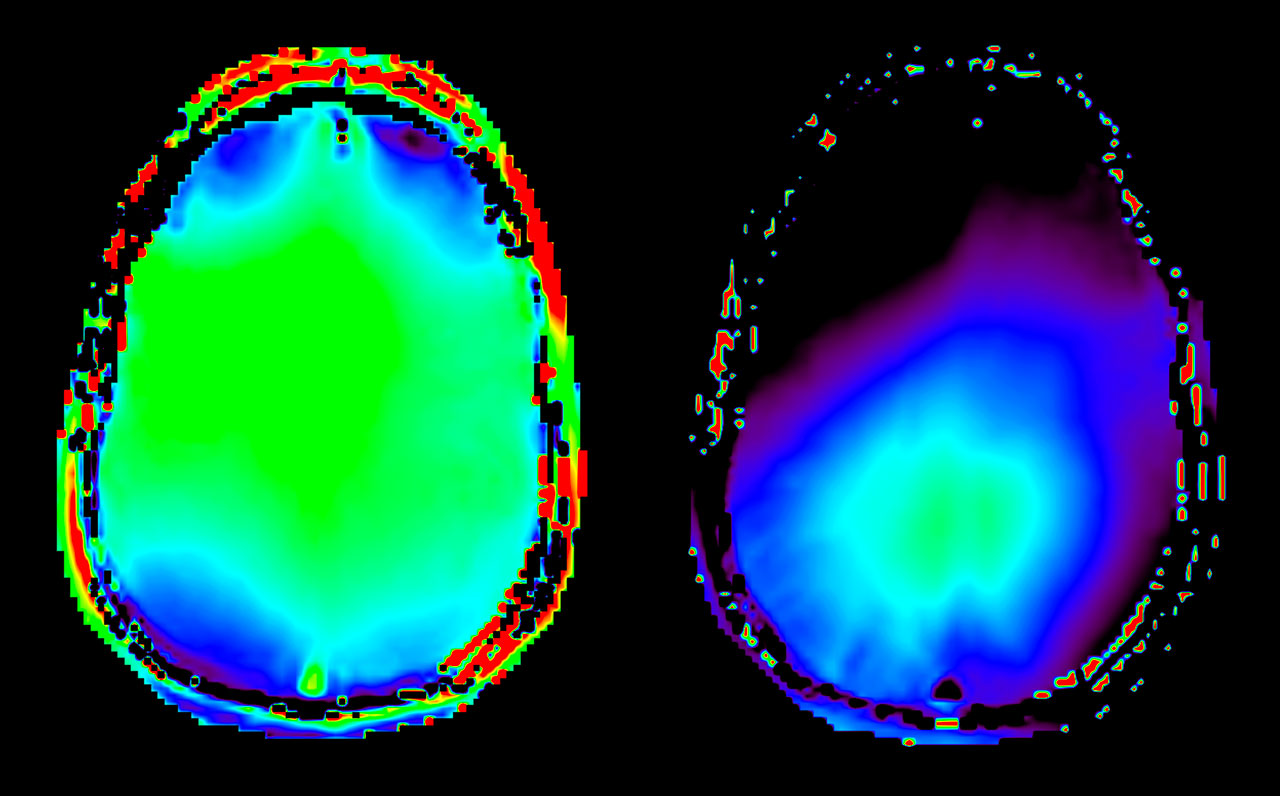 APT CEST – Olea Medical