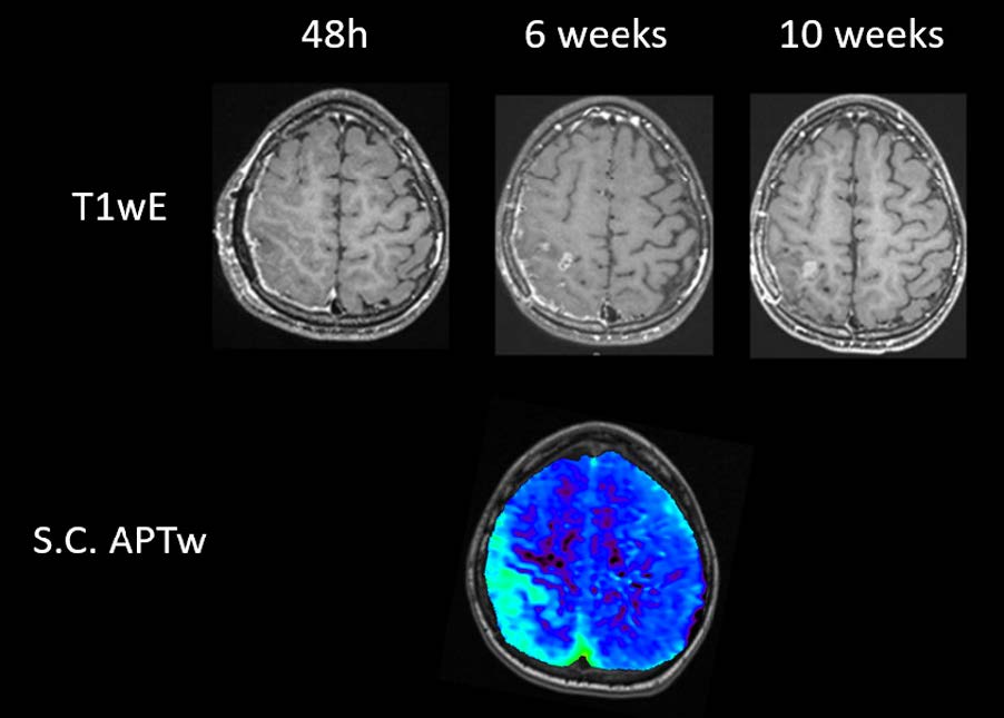 Amide Proton Transfer weighted imaging reveals a rolandic tumor in a ...