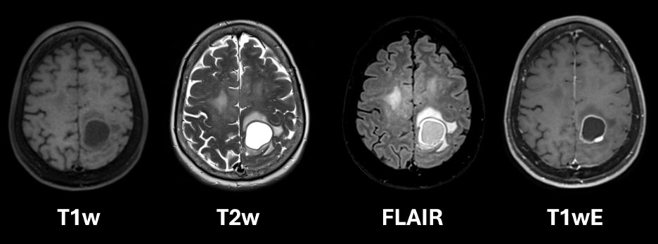 Enhancing brain tumor characterization with pCASL imaging – Olea Medical