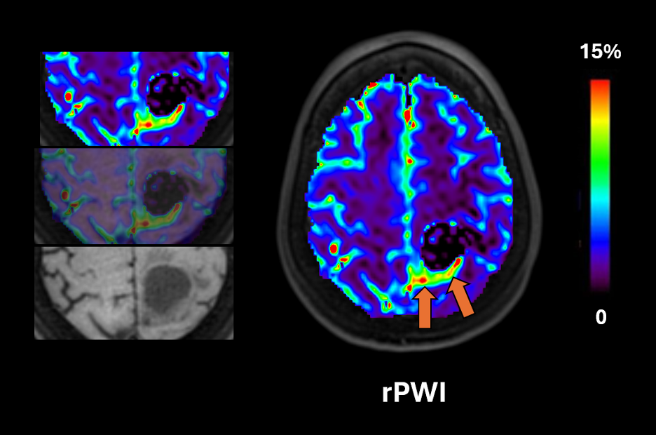 Enhancing brain tumor characterization with pCASL imaging – Olea Medical